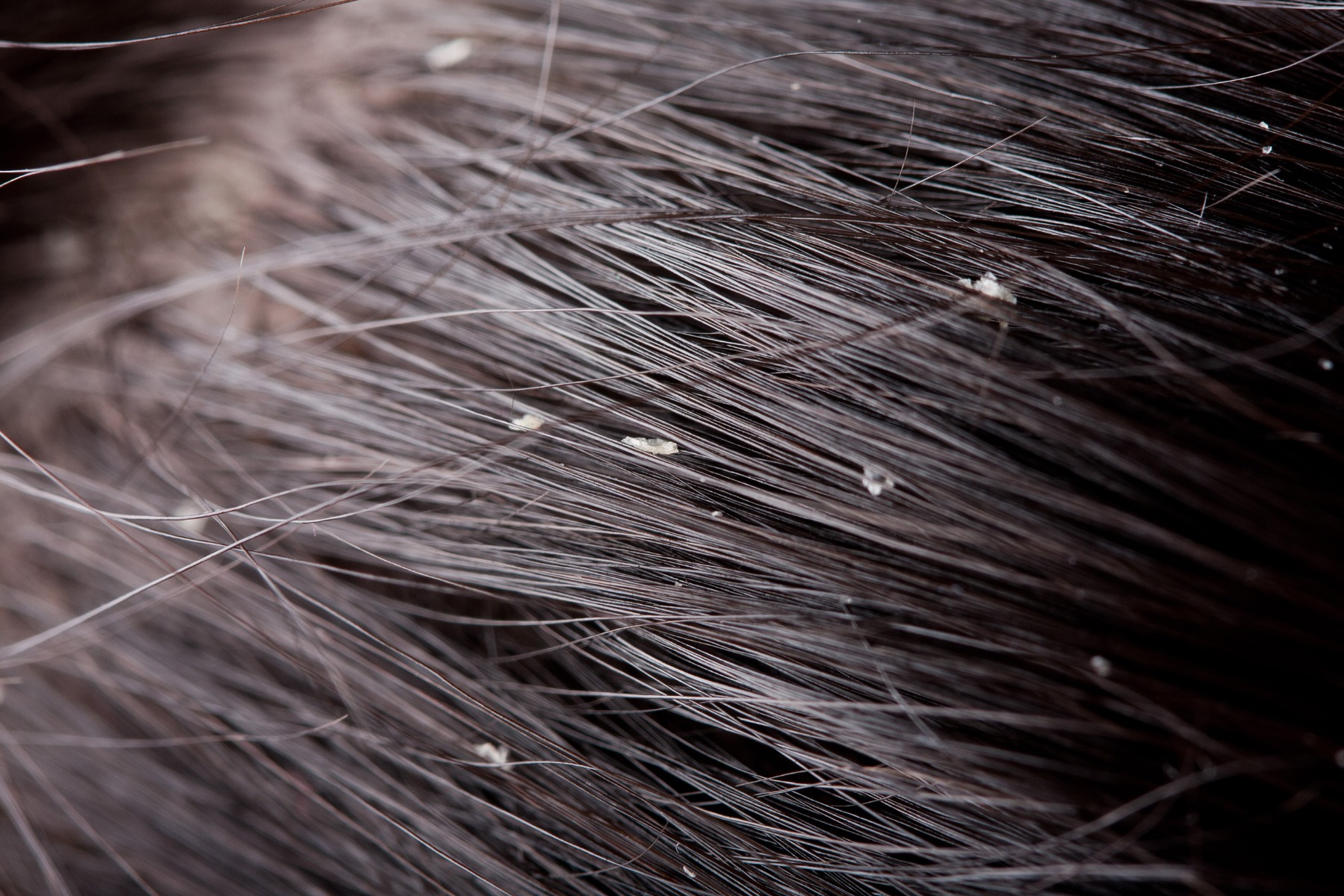 Schilfers in je haar: wat te doen tegen roos? Haarpro.nl Schilfers in je haar: wat te doen tegen roos? Haarpro.nl